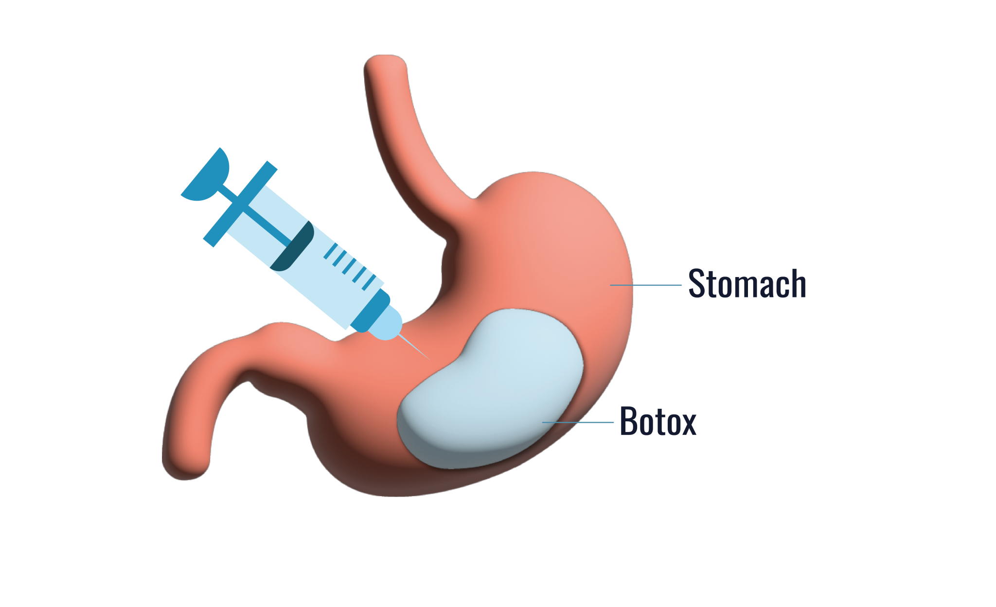 Stomach Botox – Deluxe Clinics